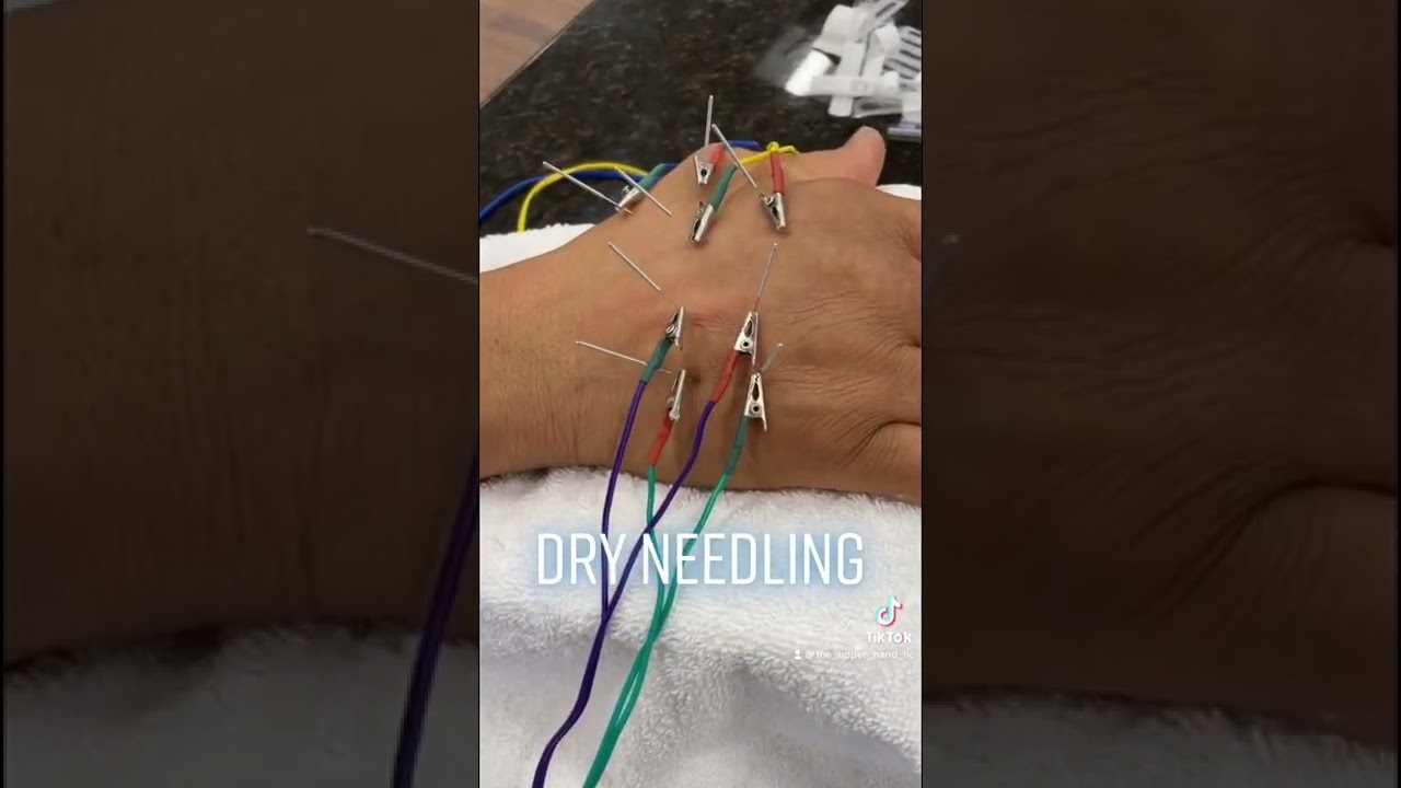 Dry Needling to the hand! - YouTube