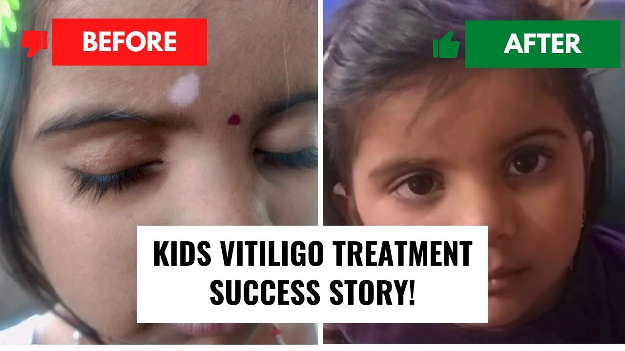 Say Goodbye to White Patches: Kids Vitiligo Treatment Success Story ...