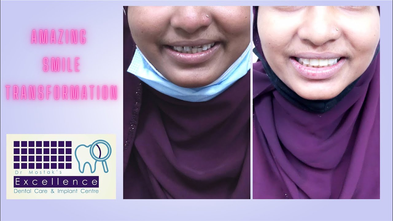 Amazing Smile Transformation||Smile Design - YouTube