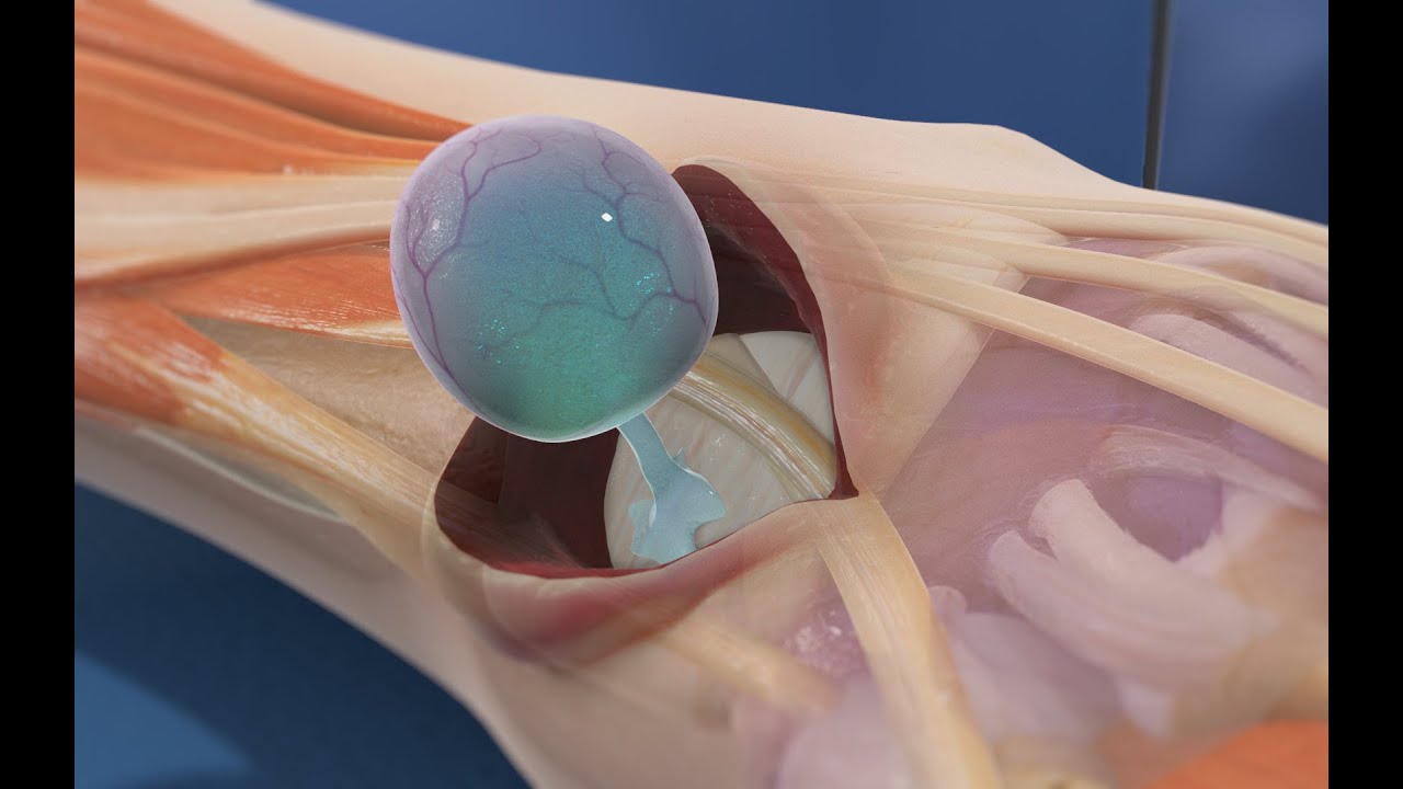 Ganglion Cyst Removal (3D Animation) - YouTube