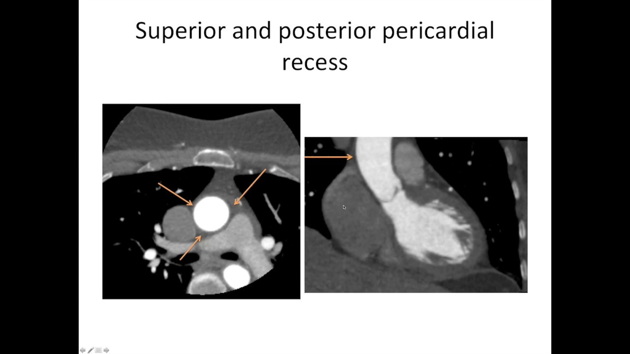 Cardiac anatomy for radiology - part 5 - pericardium - YouTube