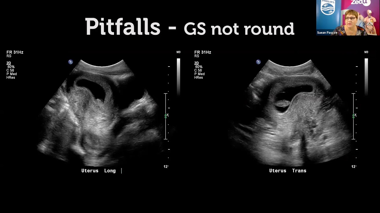 How to: Crown Rump Length & Covid-19 Lung Ultrasound - Zedu POCUS ...