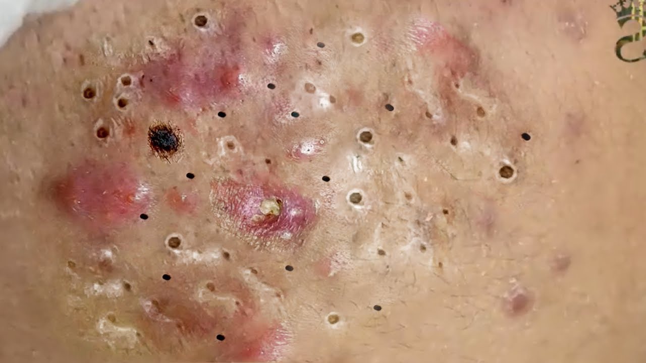 Remove blackheads and pustules At Sac Dep Spa - YouTube