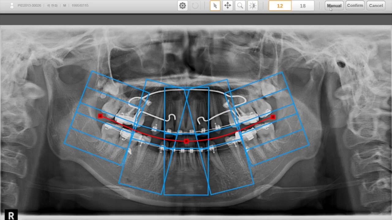 SMARTDent tutorial on RAYCAN system - YouTube