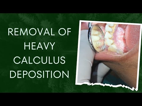 Removal of heavy calculus deposition - YouTube