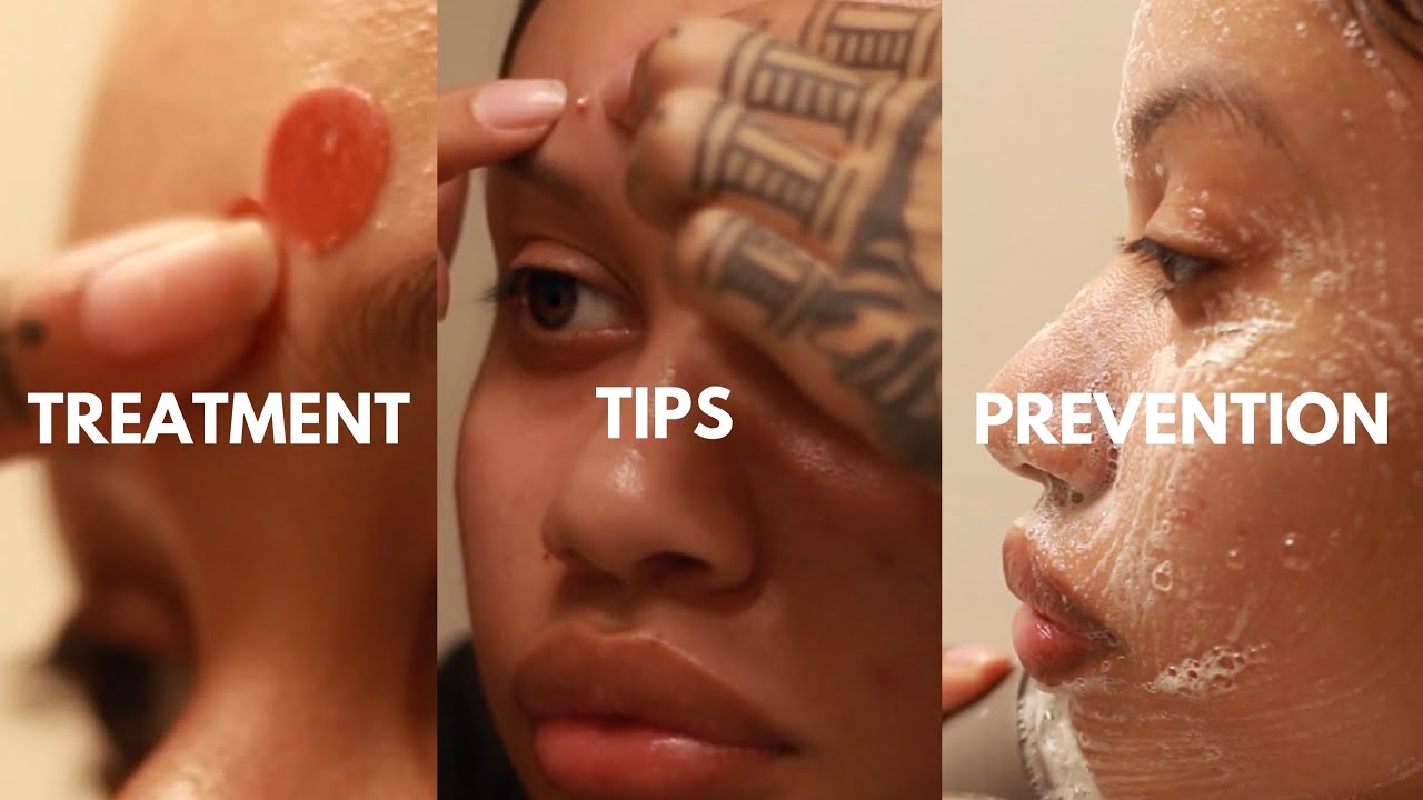 Breakout Treatment, Prevention, and Tips - YouTube