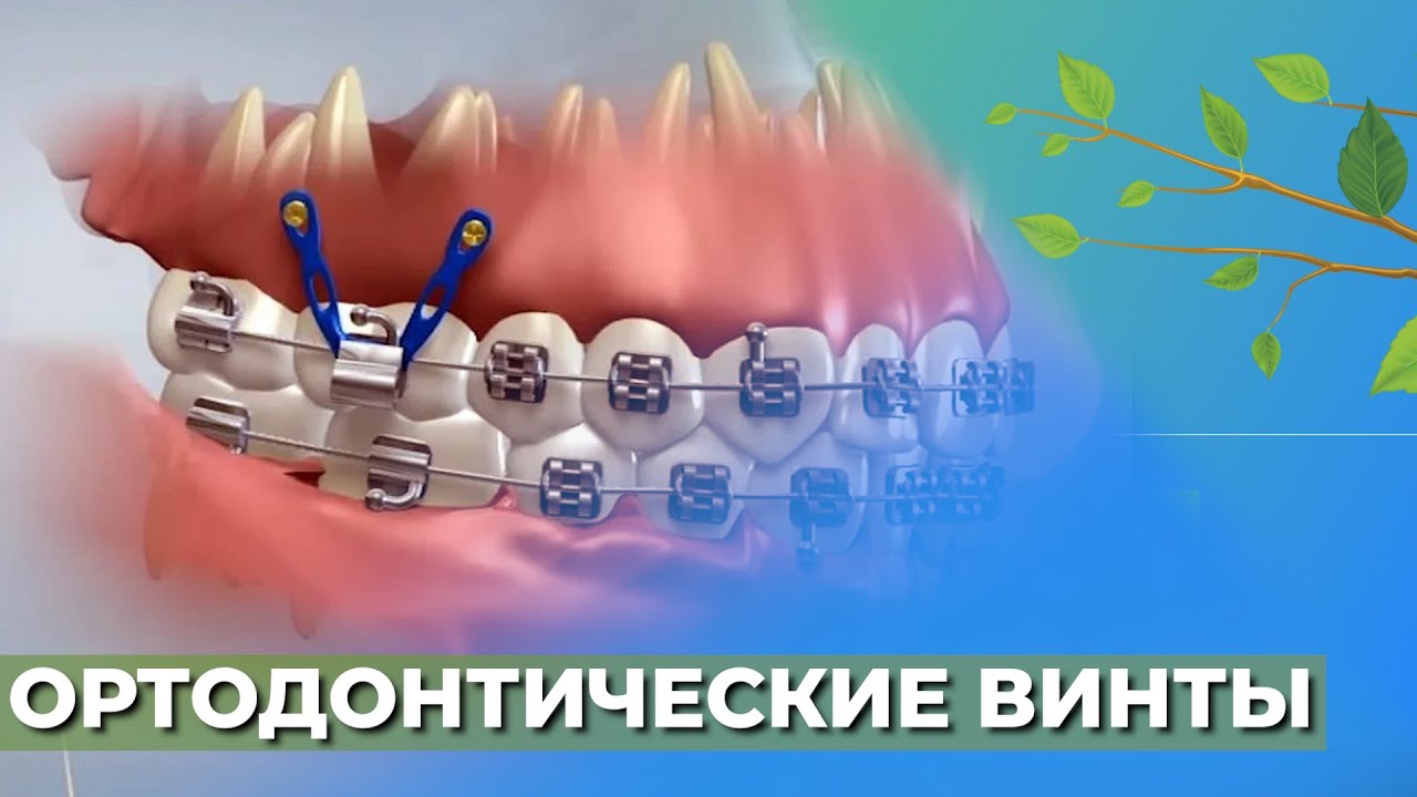 Микровинт для брекетов. Микроимплантация в ортодонтии. - YouTube