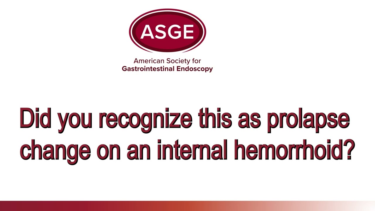 Diagnosing internal hemorrhoids with prolapse changes with Douglas Rex ...