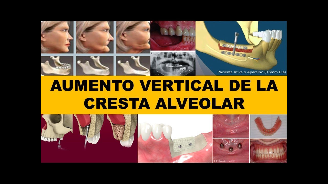 "AUMENTO VERTICAL DE LA CRESTA ALVEOLAR" - YouTube