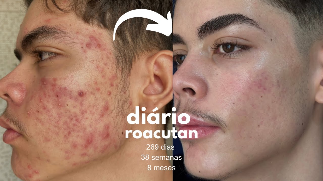 DIÁRIO DE ROACUTAN: FIM DE TRATAMENTO | 269 DIAS, 38 SEMANAS, 8 MESES ...