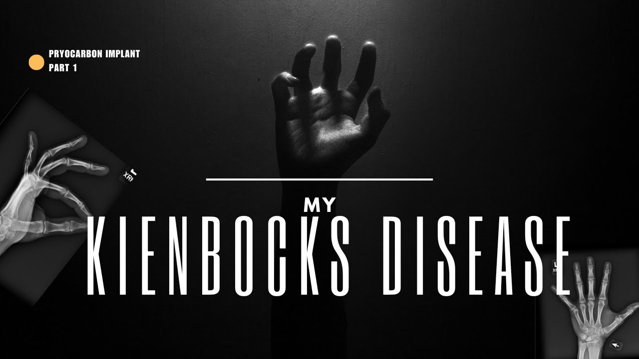 My Kienbocks Disease PART-1 Late Stage Lunate replaced with Pyrocarbon ...