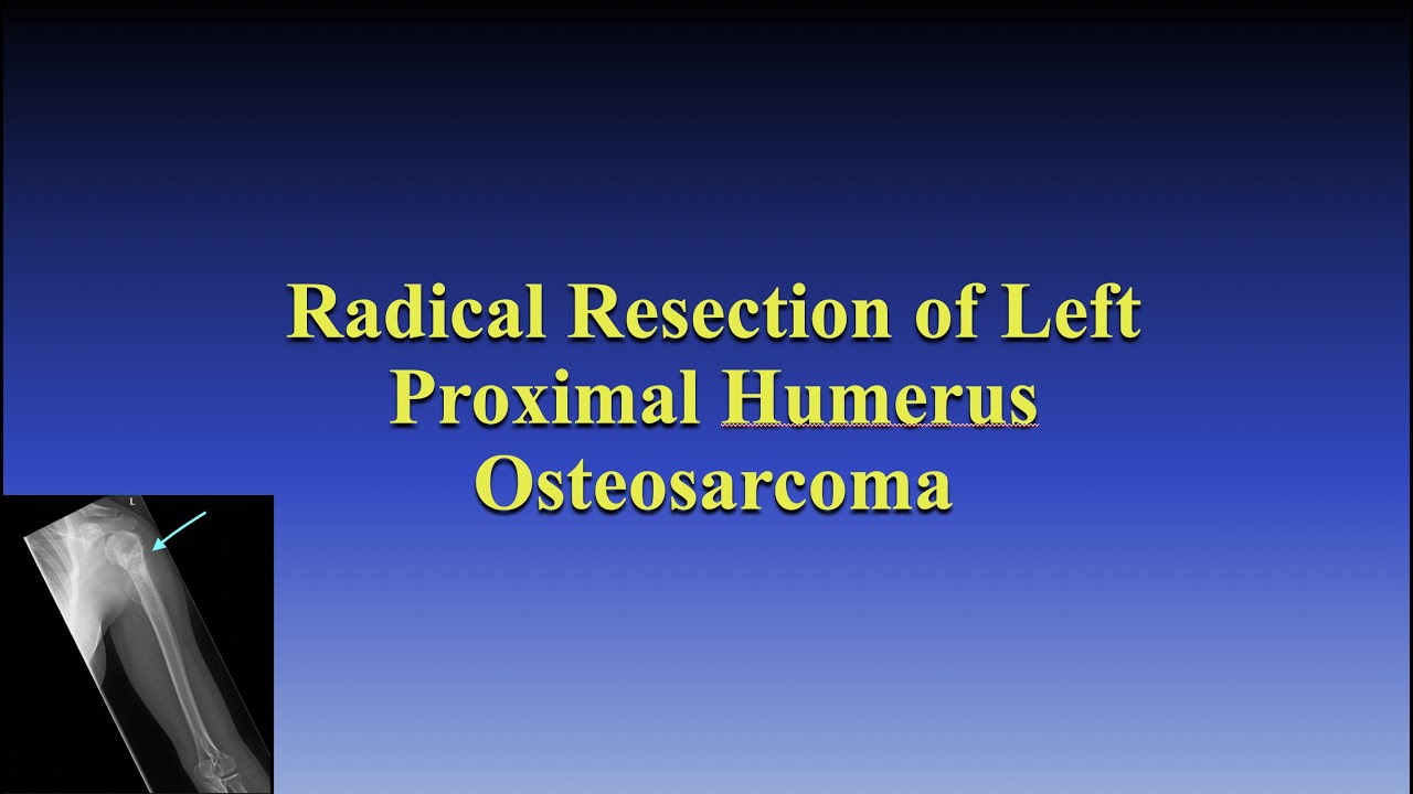 Limb Sparing Resection of the Proximal Humerus due to an Osteosarcoma ...