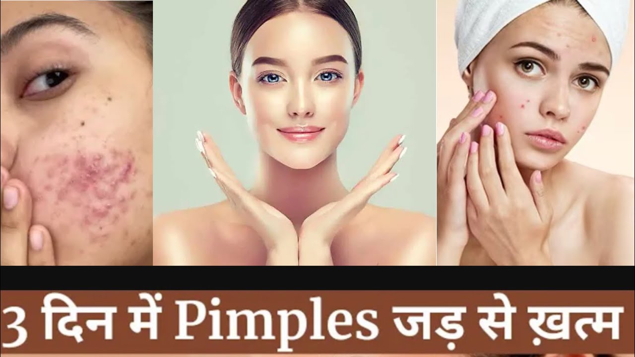 3 DAYS EFFECTIVE PIMPLES SOLUTION | SHOCKING RESULTS 🙀|NO PIMPLES ON ...
