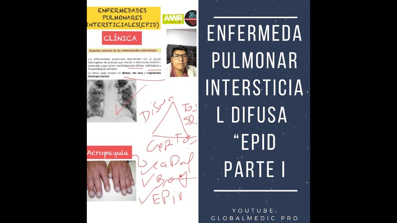 EPID FÁCIL EXPLICADO - YouTube