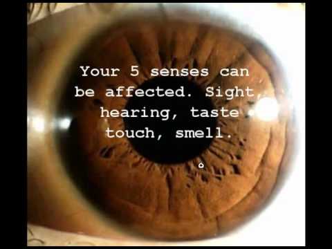 Iridology Lesson #6: Radii Solaris - Toxic Tunnels to the Brain - YouTube