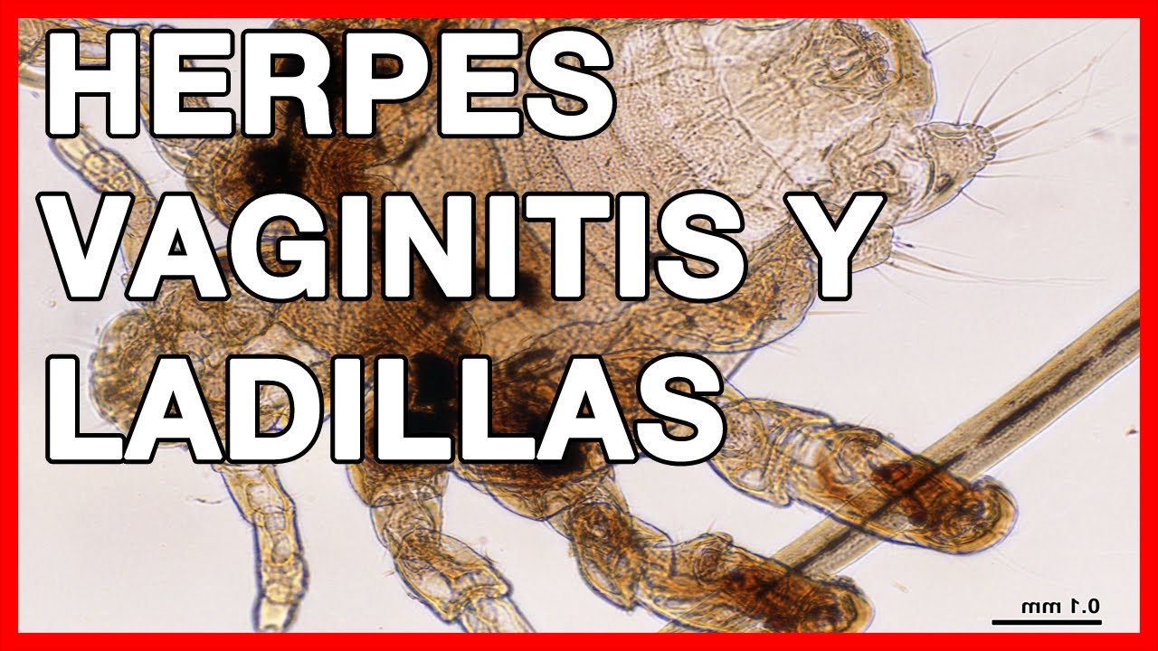 Sintomas de Herpes, Vaginitis y Ladillas - YouTube