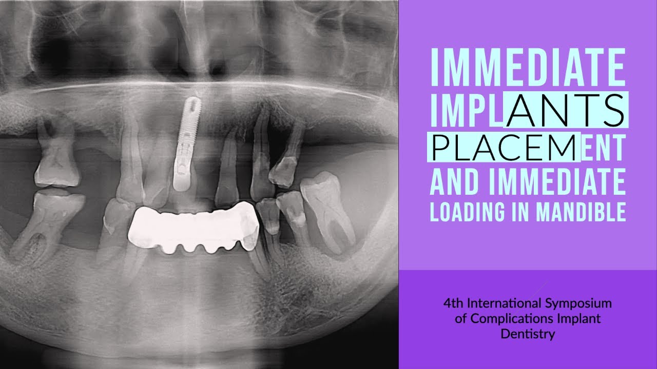 Immediate Implants Placement and Immediate Loading in Mandible - YouTube