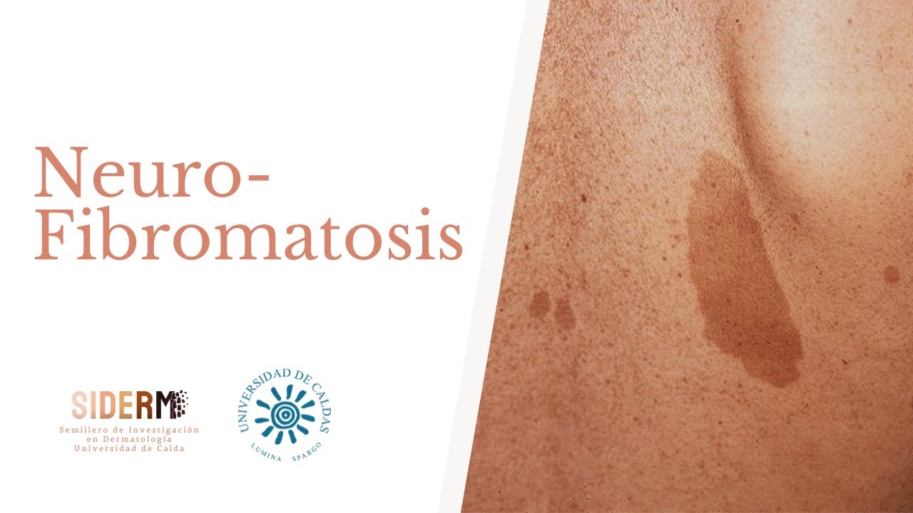 Revisión Neurofibromatosis - YouTube