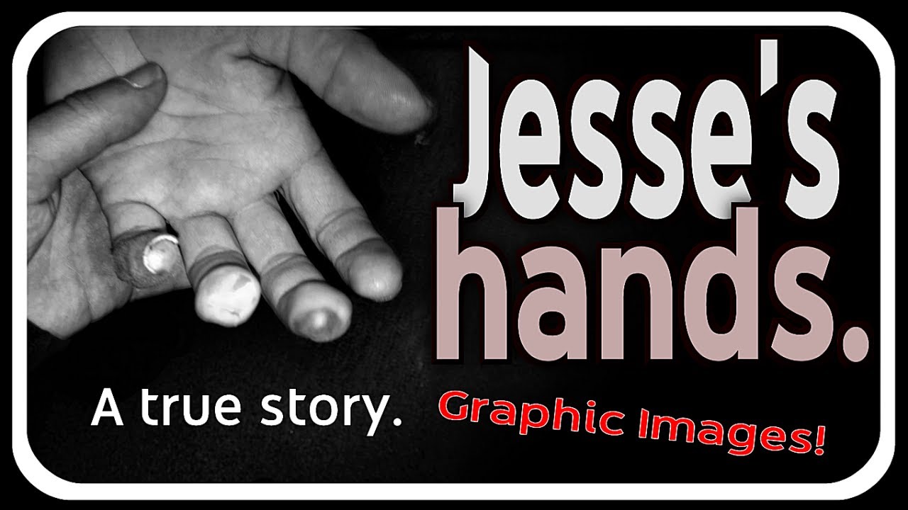 Jesse's hands (A true story) - YouTube
