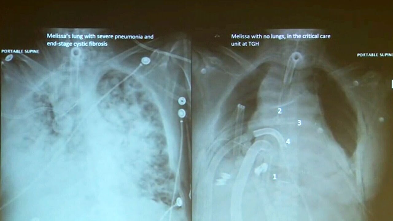 Ground-breaking surgery keeps woman alive without lungs - YouTube