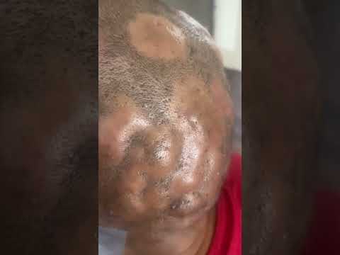 How to bust cyst at home - YouTube