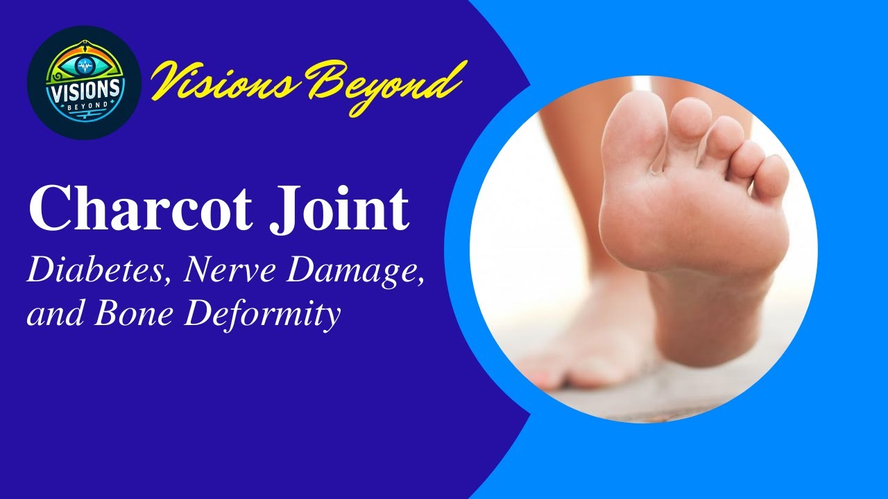 Charcot Joint: Diabetes, Nerve Damage, and Bone Deformity - YouTube