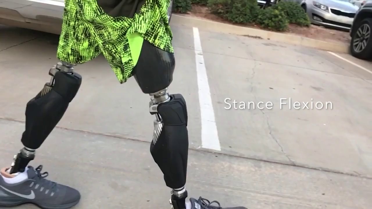 Bilateral Above Knee Microprocessor Knee Technology - YouTube