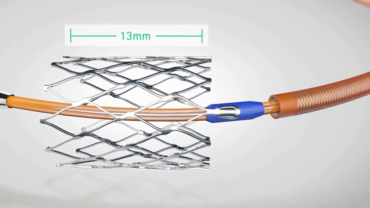MSDS-Multiple Stent Delivery System VascuFlex Multi LOC - YouTube