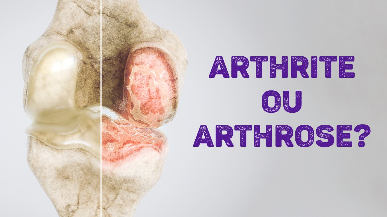 Voici comment distinguer ARTHRITE et ARTHROSE! - YouTube