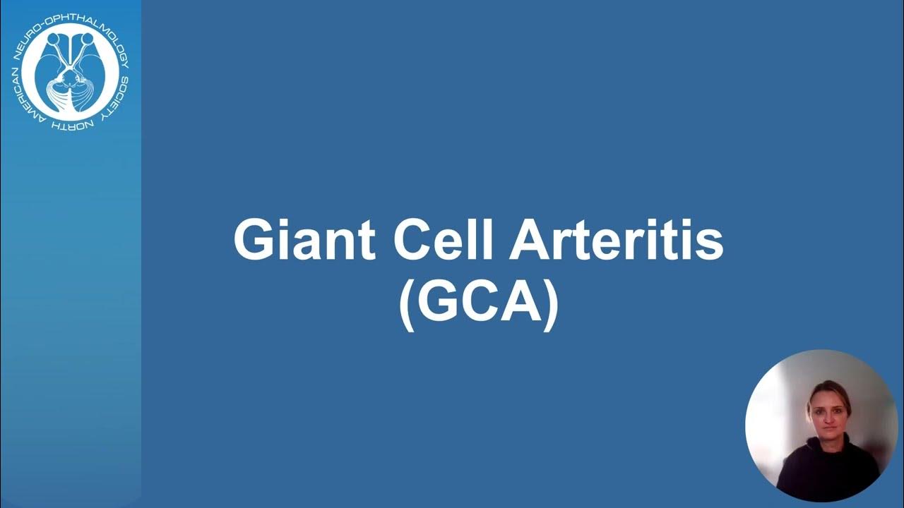 Understanding Giant Cell Arteritis (GCA): Causes, Symptoms, and ...