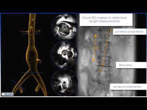 Visions PV .035 Digital IVUS Catheter Animation - YouTube
