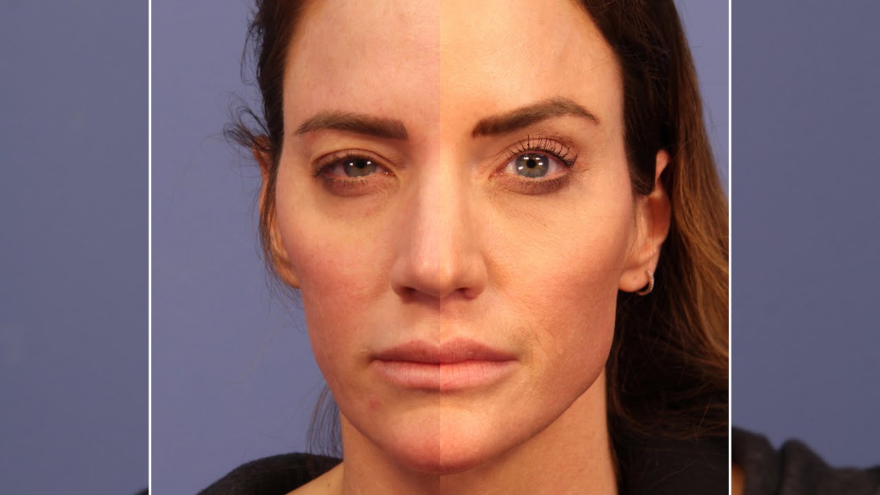 Cary Deuber face surgery BEFORE + AFTER!! - YouTube