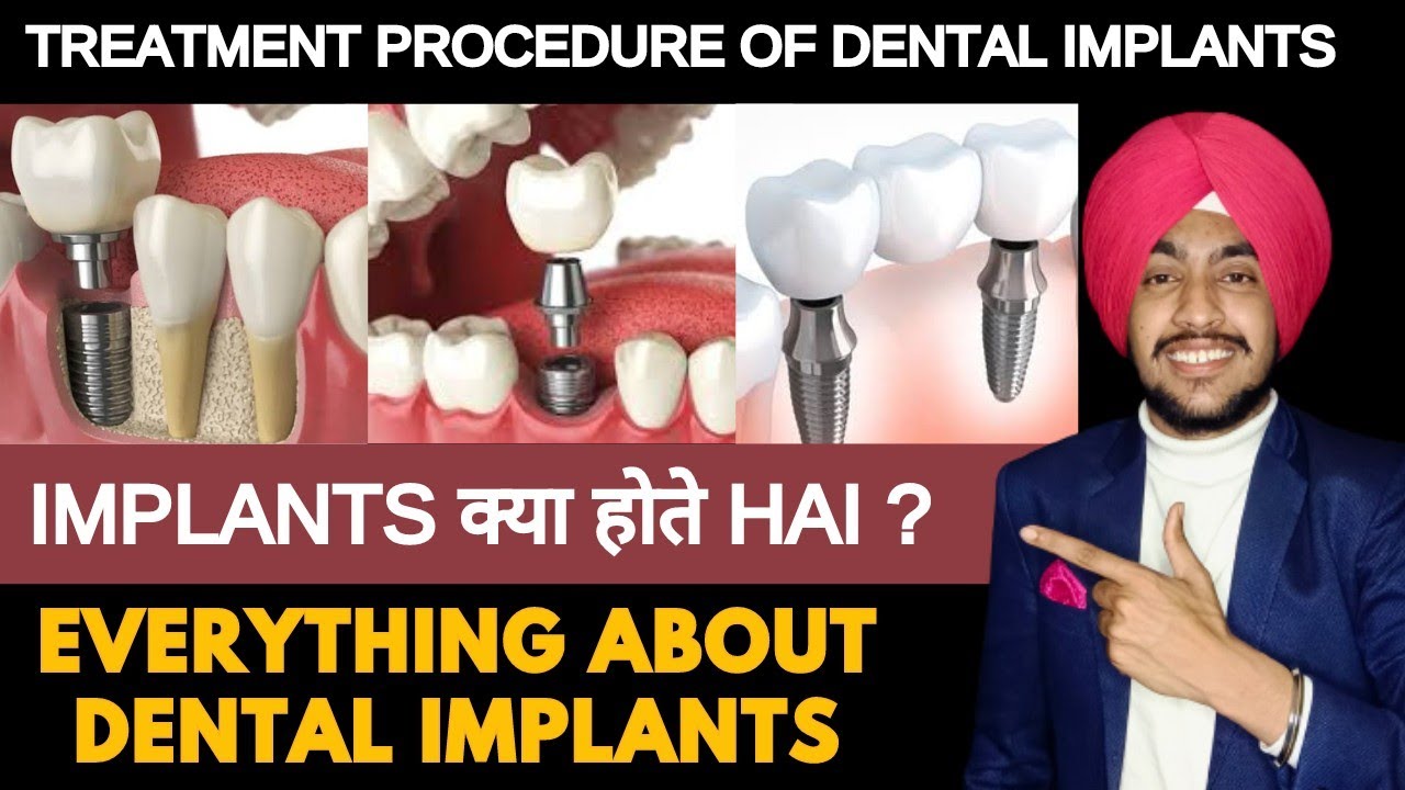 Everything about Dental Implants | Complete Procedure | Post Operative ...