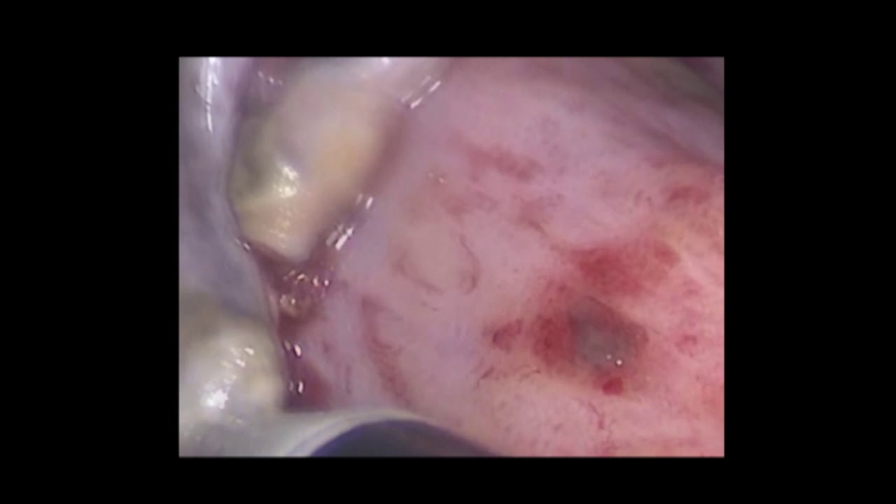 Peritonitis Fecal por Perforación Traumática de Recto - YouTube