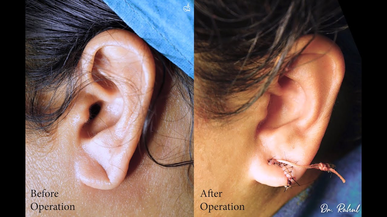 HOLE PRESERVING EAR LOBULE REPAIR - YouTube