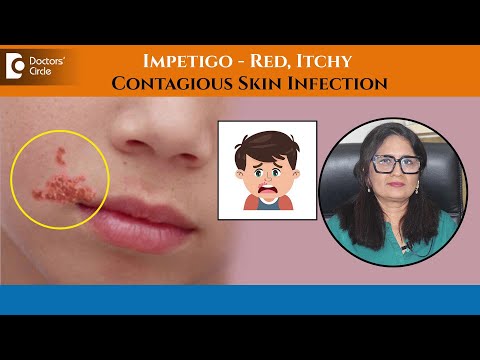 How to Cure Bacterial Skin Infection IMPETIGO?|Causes & Prevention-Dr.Aruna Prasad | Doctors' Circle