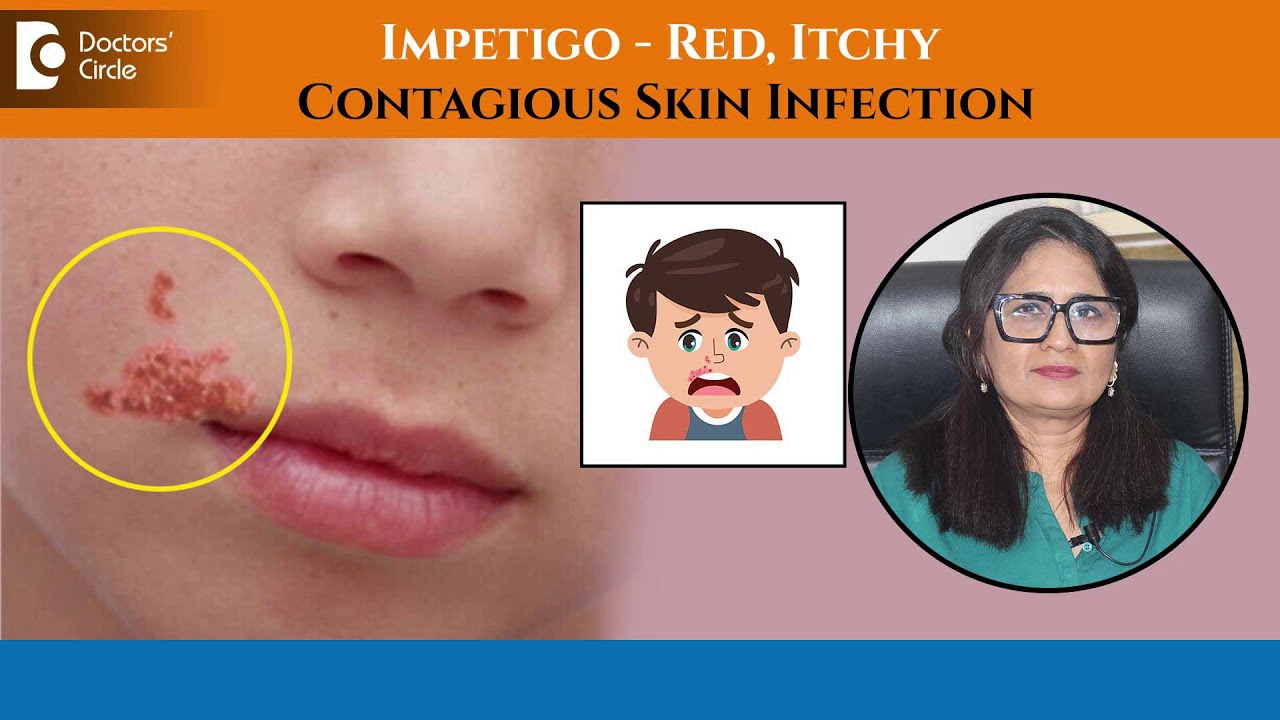 How to Cure Bacterial Skin Infection IMPETIGO?|Causes & Prevention-Dr ...