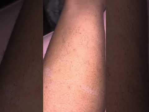 ASMR super zoom ingrown leg hair removal and scratching 