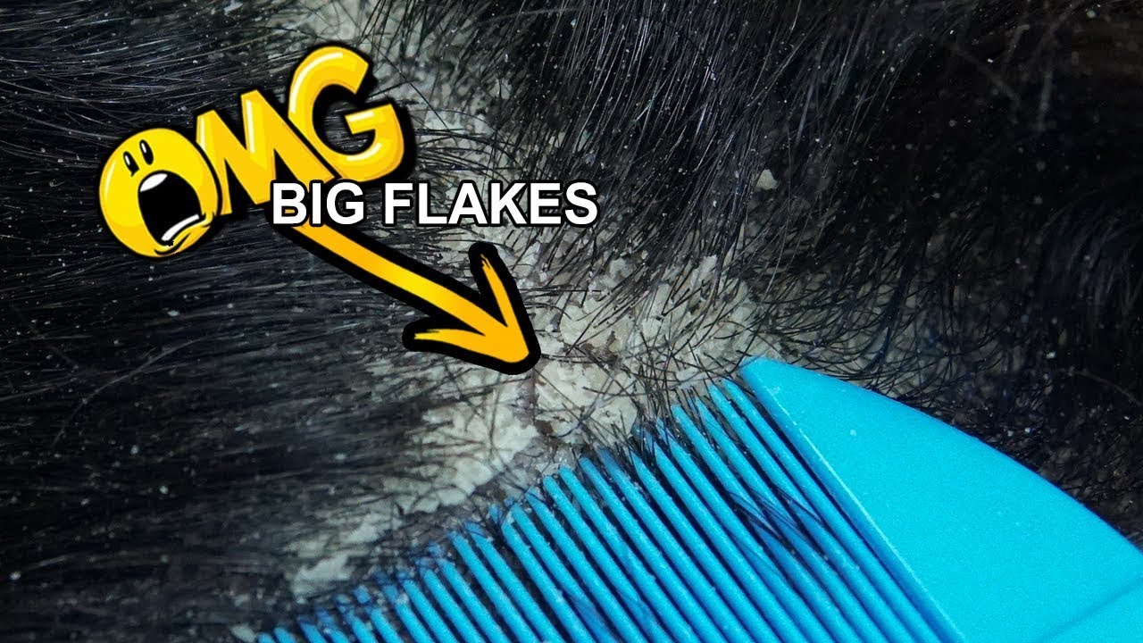Very Huge Dandruff On Scalp!! Dandruff Removal With Black Comb - YouTube