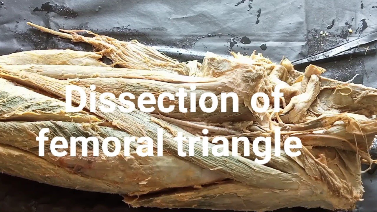 Dissection of femoral triangle| Anatomy of femoral Triangle| Femoral ...