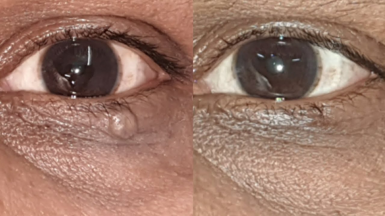 Sebaceous cyst on eyelid - YouTube