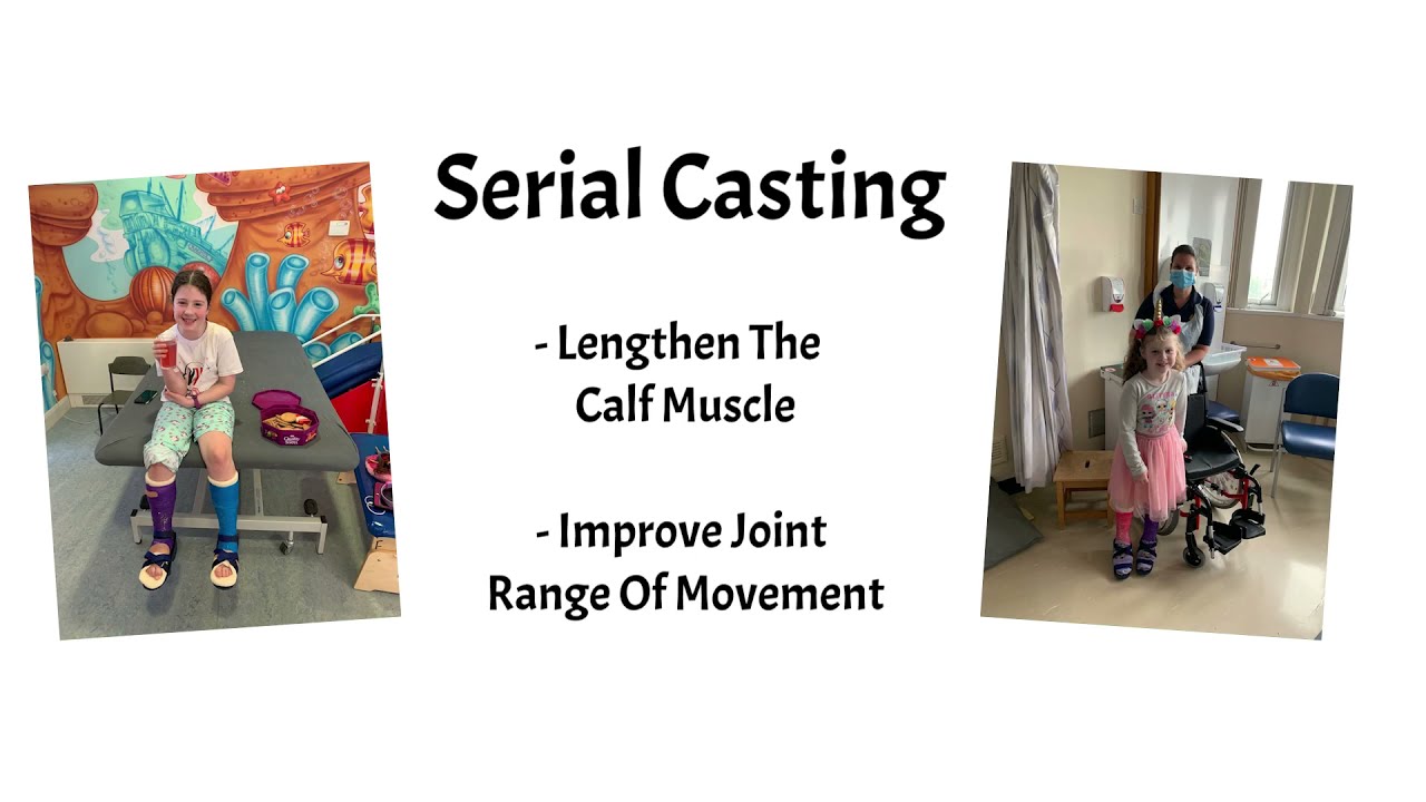 A&S Showcase | Physiotherapy led local serial casting service - YouTube