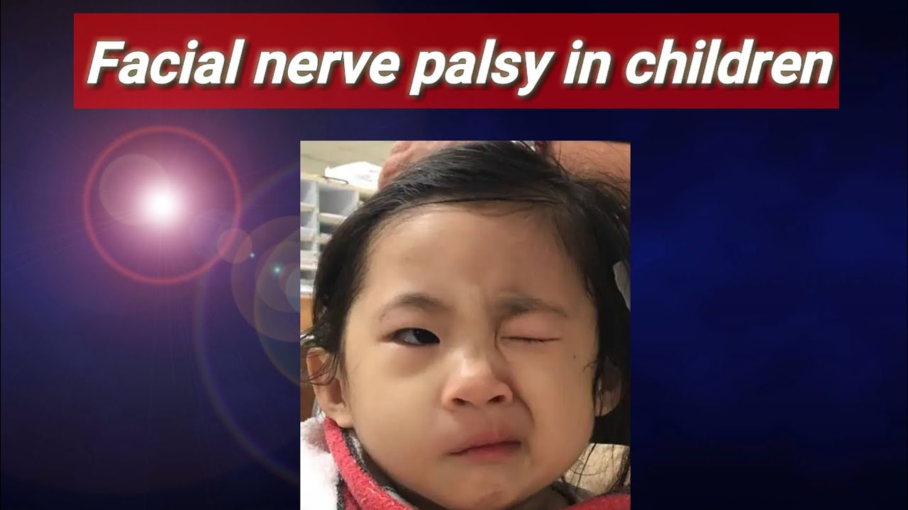 left sided facial palsy - YouTube