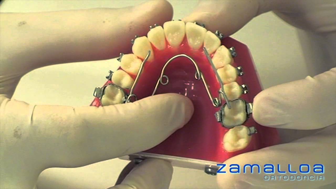 Quad helix en ortodoncia: en qué consiste | Ortodoncia Zamalloa - YouTube