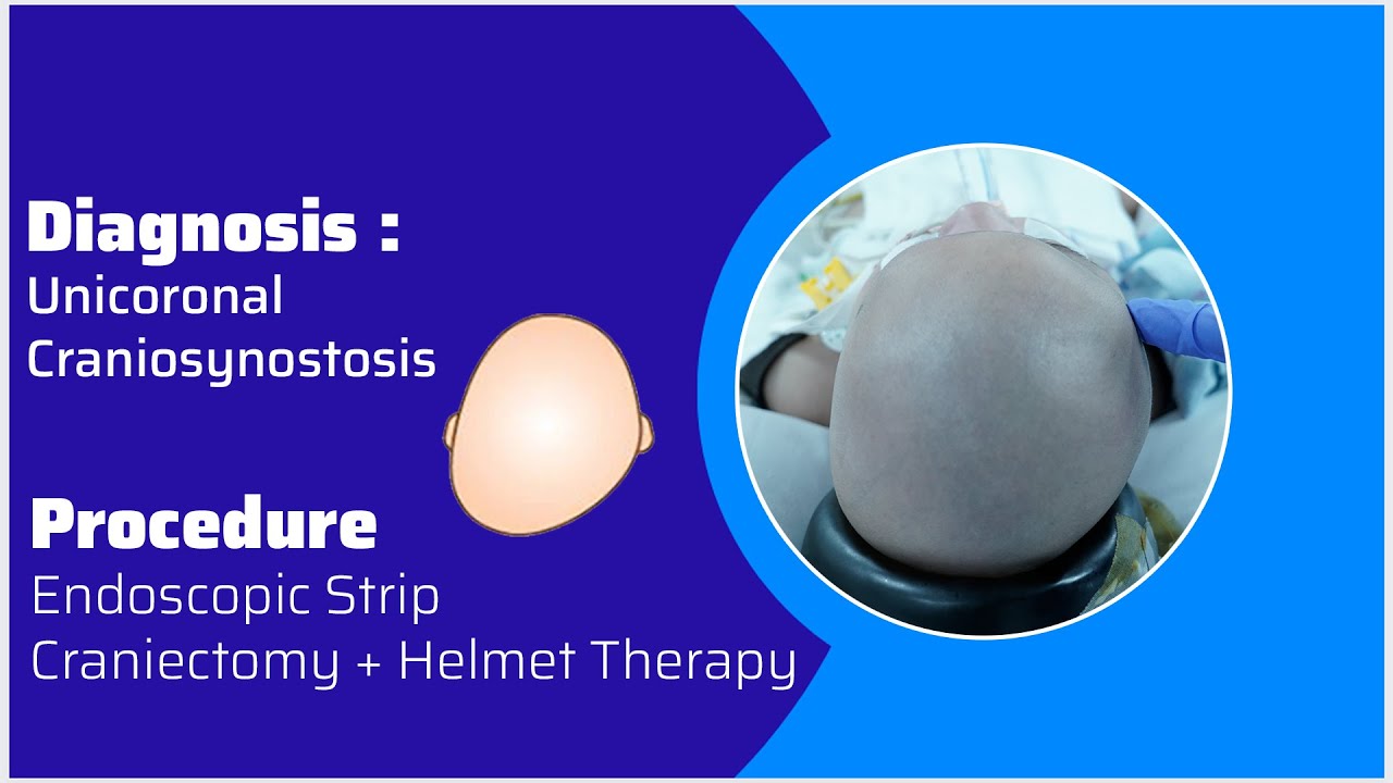 Treatment for twisted or slanted head in Babies | Endoscopic Strip ...