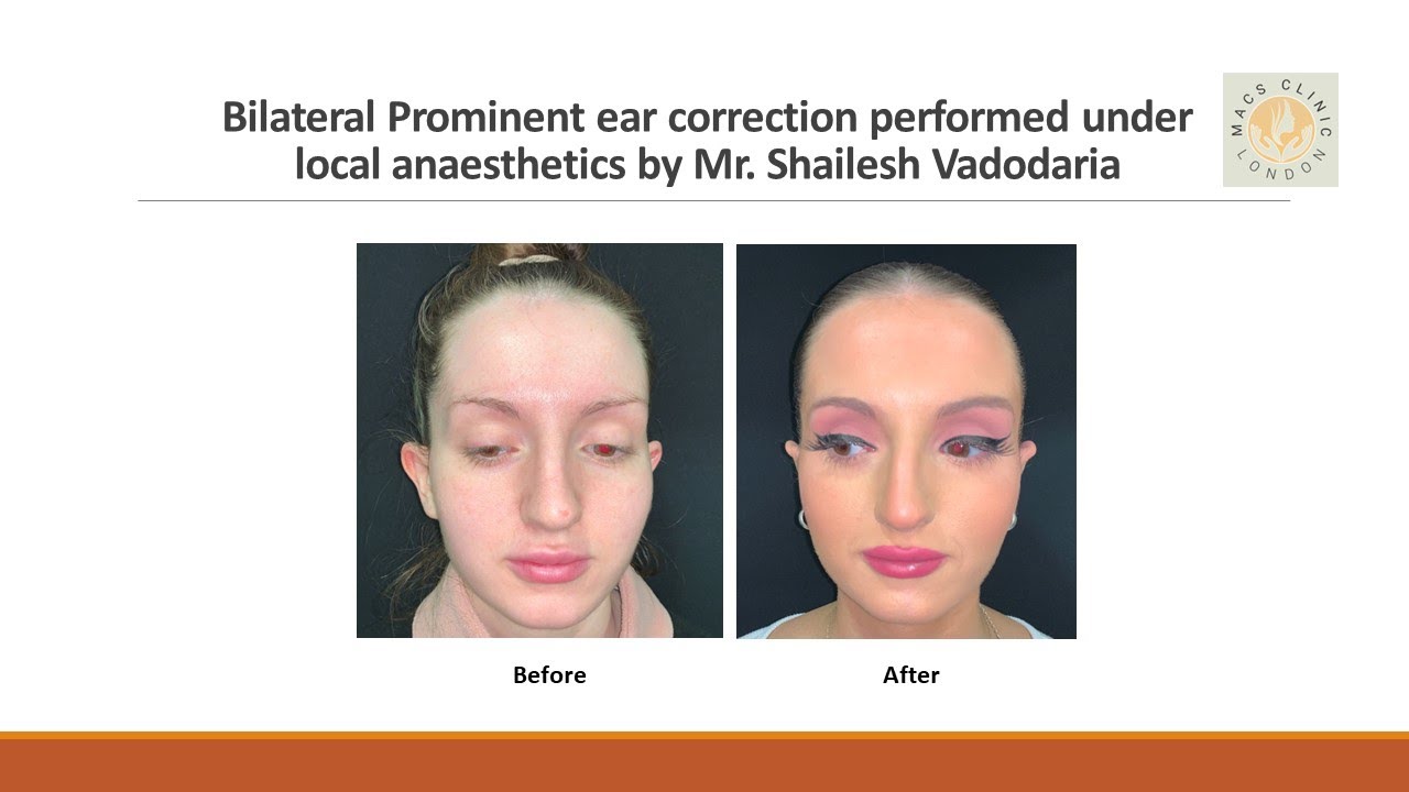 Testimonial by a happy patient following bilateral prominent ear ...