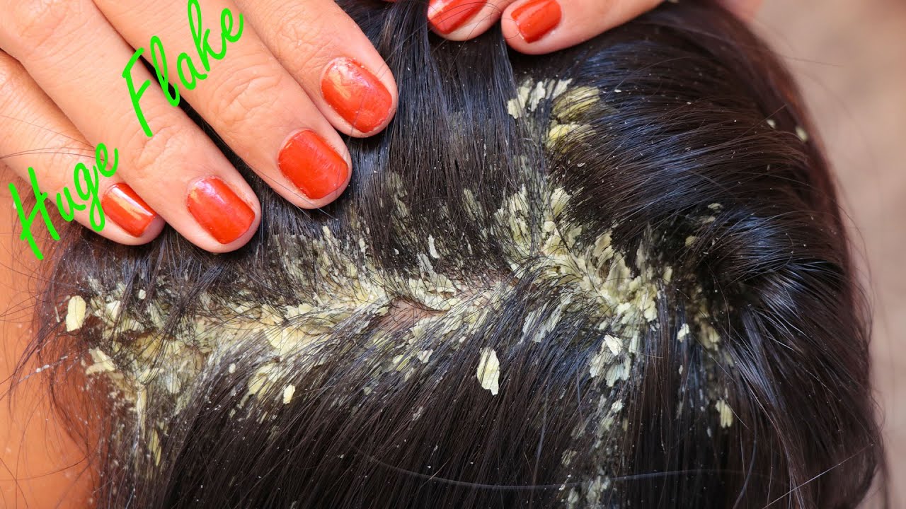 SCRATCHING Big Flakes !! Scalp Dry Dandruff Unique one Comb # 267 - YouTube