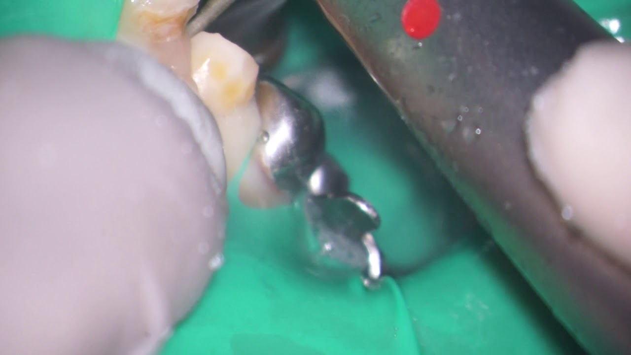 Preparation of upper primary canine for NuSmile ZR Crown - YouTube