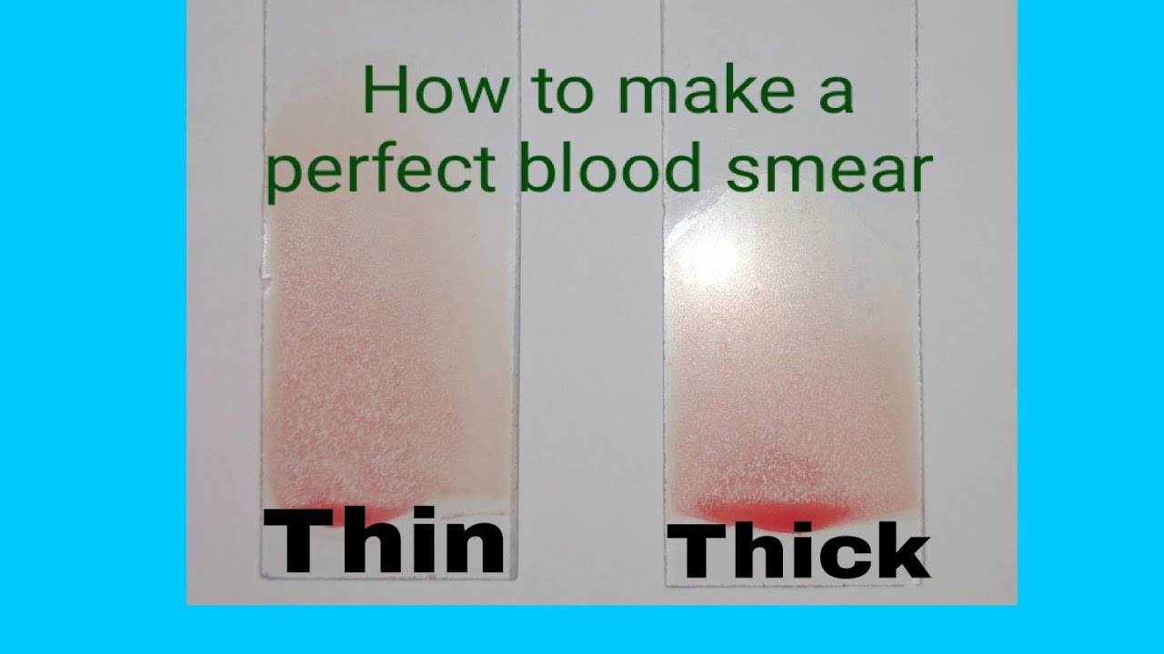 How to make a perfect blood smear|blood smear technique|easy making ...