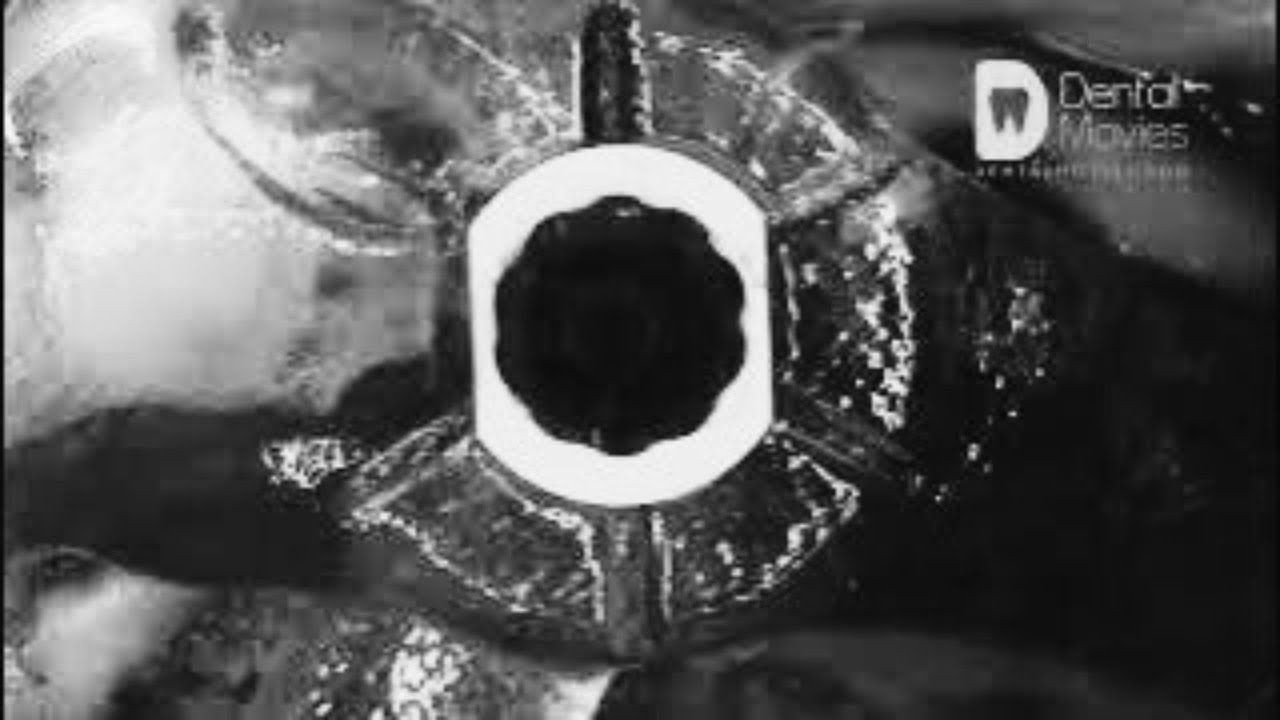 Implantation using a template & bone augmentation - YouTube